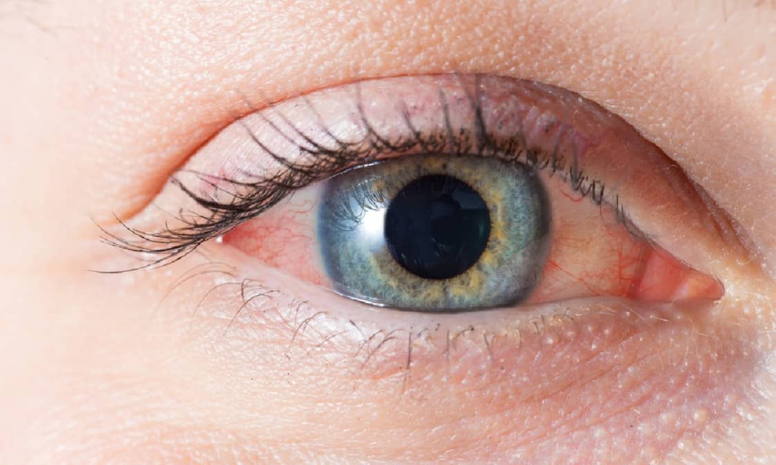 Crveno oko - preporuka ljekarnika - JGL