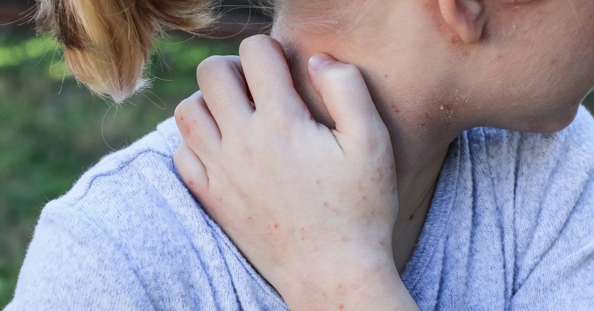 What types of psoriasis are common in children? - Sharecare