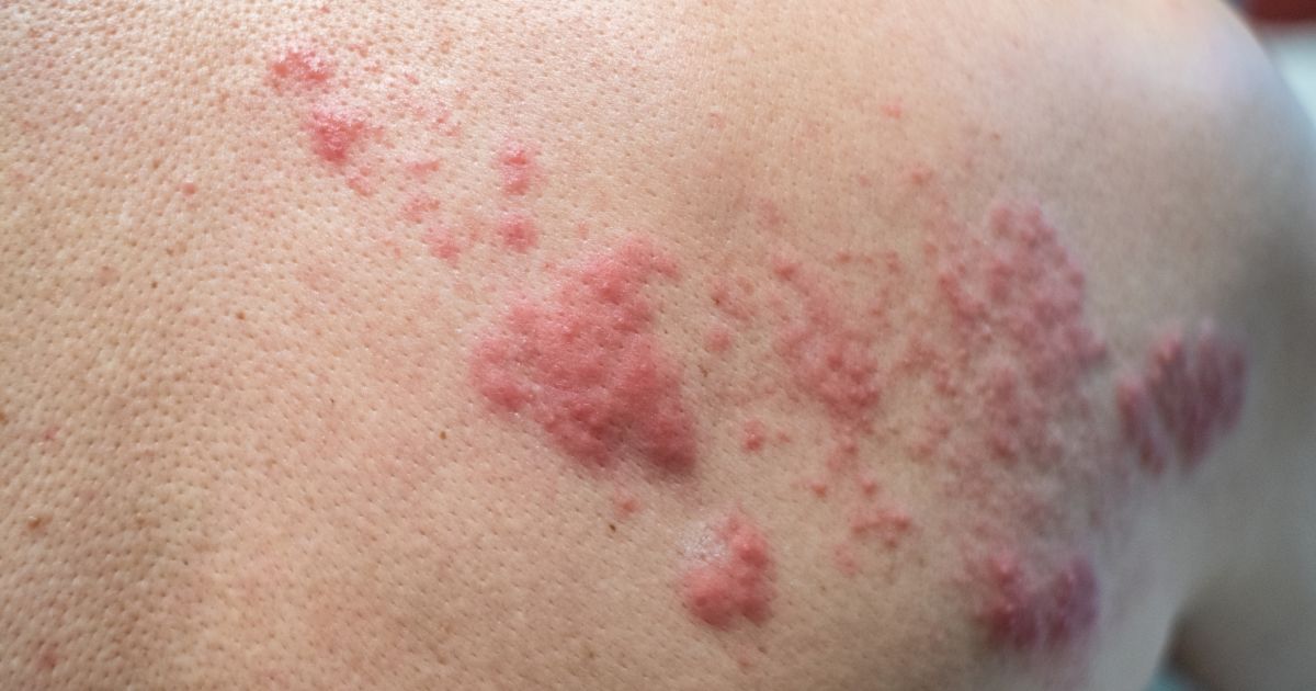What to know about shingles - Sharecare