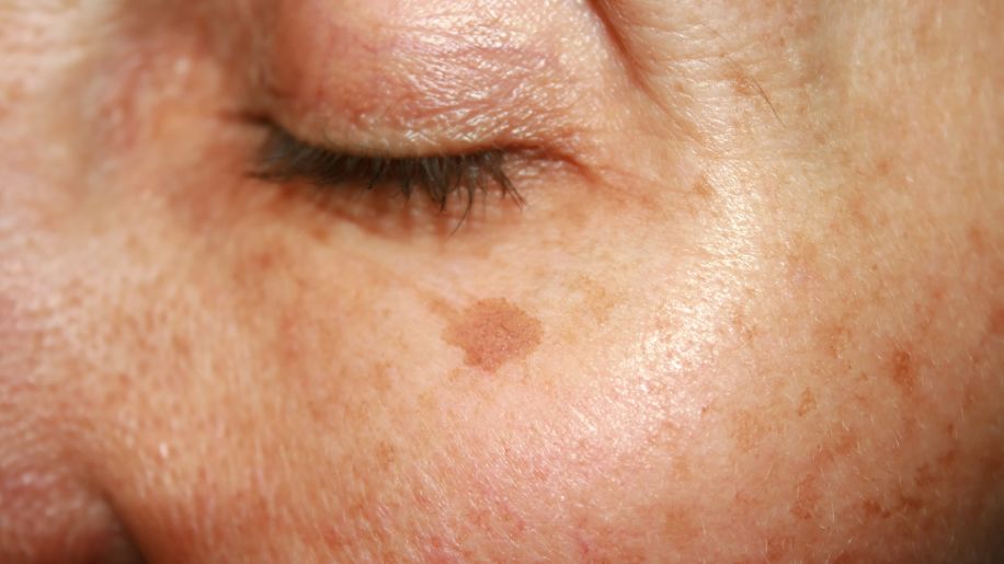 What Does Skin Cancer Really Look Like? | cancer - Sharecare