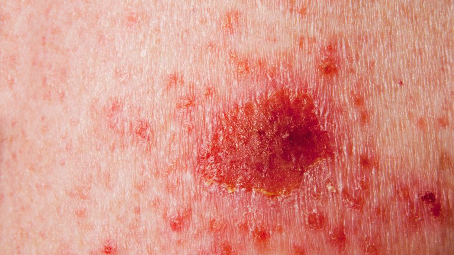What Does Skin Cancer Really Look Like? | cancer - Sharecare