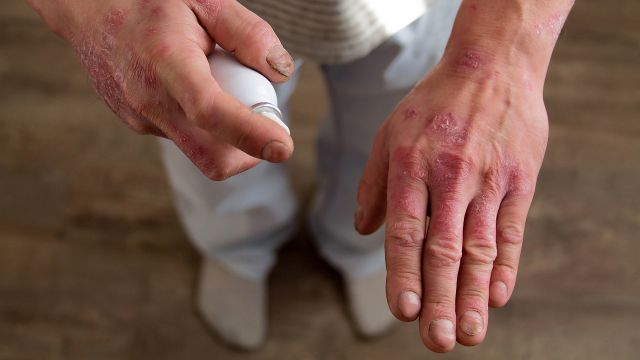 Is Psoriasis Mild, Moderate or Severe? - Sharecare